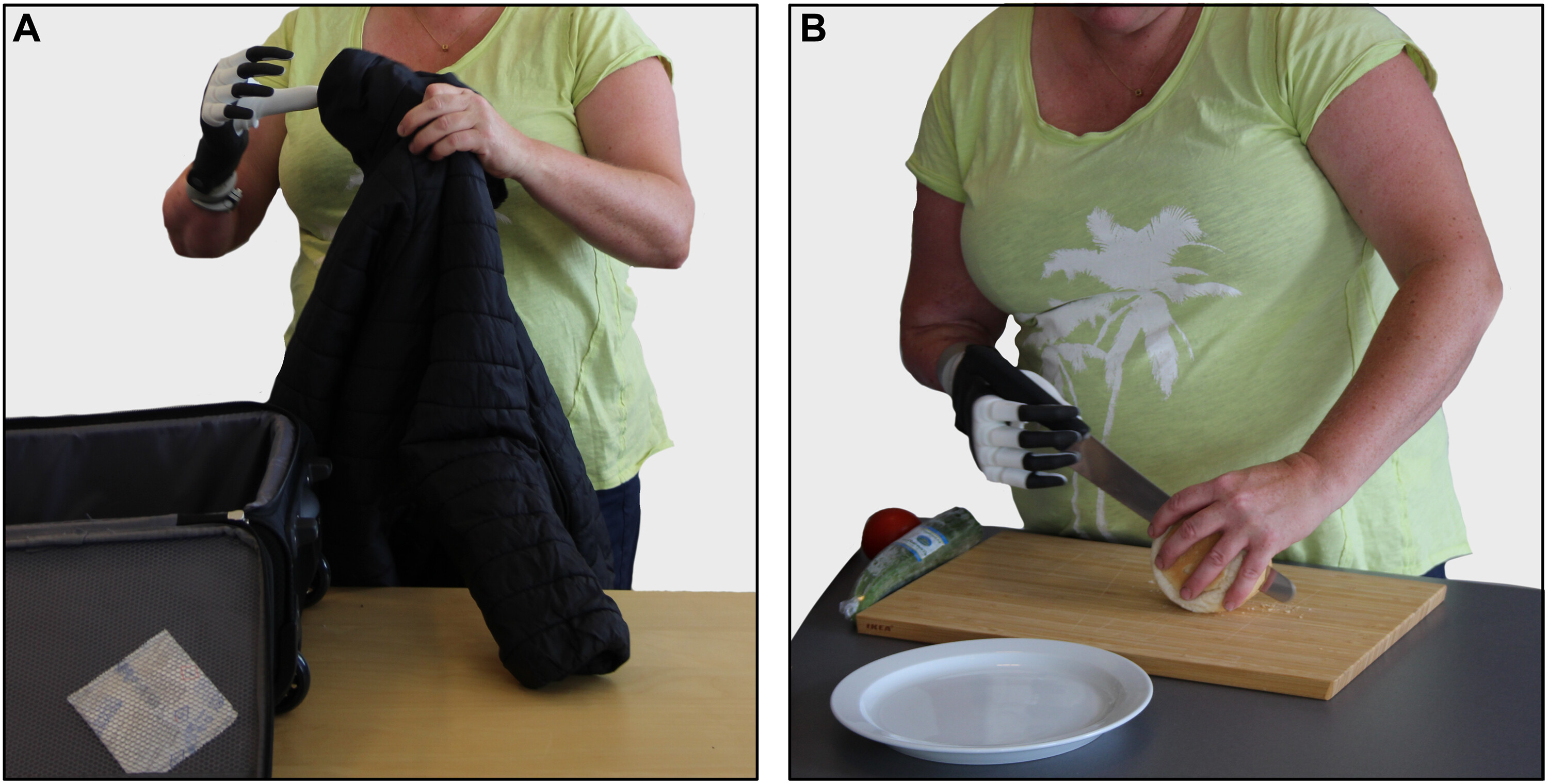 Prótesis revolucionaria: logran fusionar exitosamente mano biónica con ...